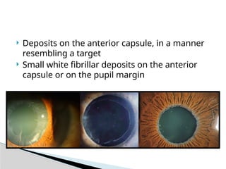 Pseudoexfoliative glaucoma and pseudo exfoliative syndrome | PPTX