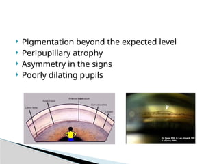 Pseudoexfoliative glaucoma and pseudo exfoliative syndrome | PPTX