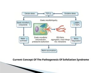 Pseudoexfoliative glaucoma and pseudo exfoliative syndrome | PPTX