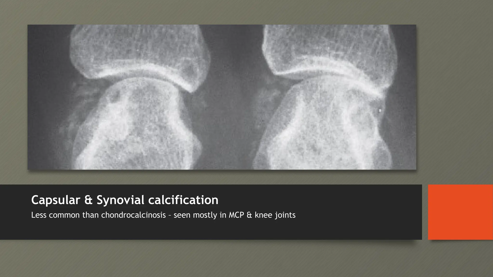 "Pseudogout or Calcium Pyrophosphate Deposition Disease: Diagnosis ...