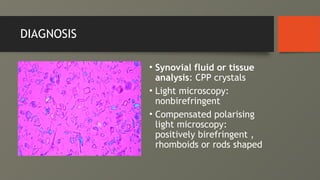 "Pseudogout or Calcium Pyrophosphate Deposition Disease: Diagnosis ...