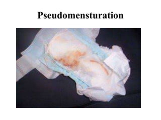 Pseudomensturation.pptx