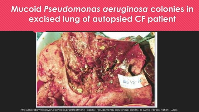 Pseudomonas aeruginosa mini-presentation | PPTX