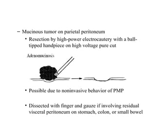 Pseudomyxoma peritonei | PPT