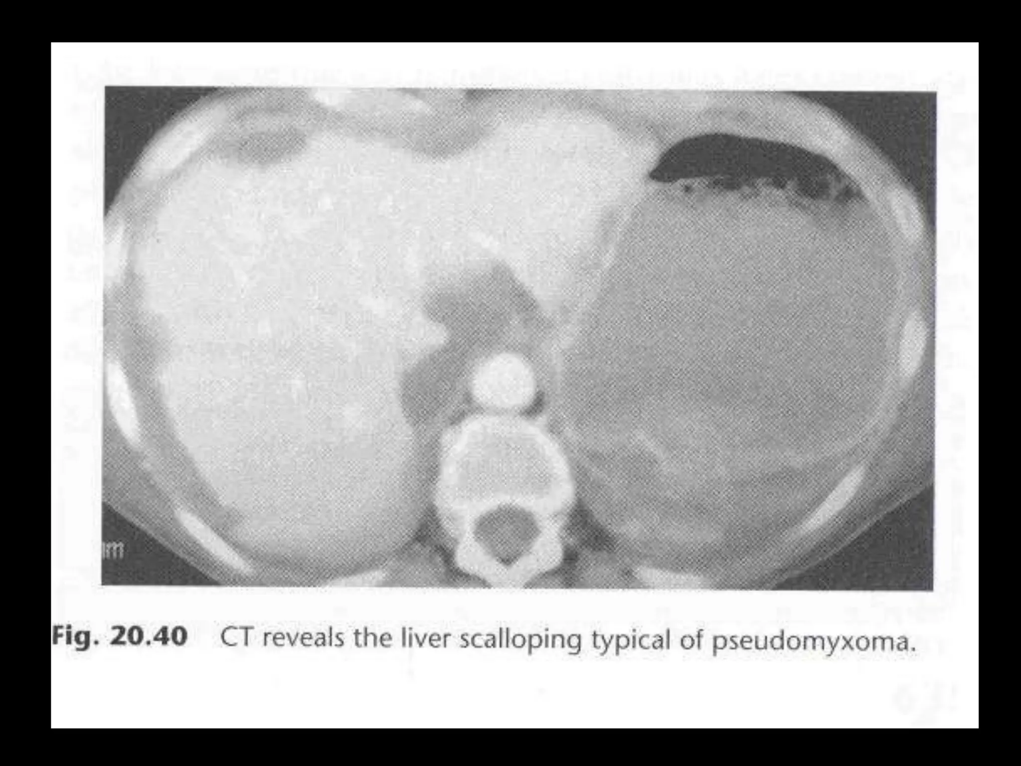 Pseudomyxoma Peritonei the lect.ppt