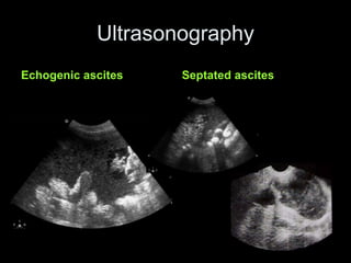Pseudomyxoma Peritonei the lect.ppt