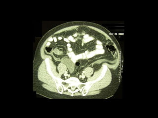 Pseudomyxoma Peritonei the lect.ppt