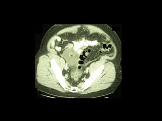 Pseudomyxoma Peritonei the lect.ppt