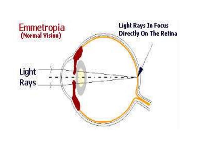 Pseudophakia | PPTX | Eye and Vision Conditions | Diseases and Conditions