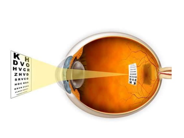 Pseudophakia | PPTX | Eye and Vision Conditions | Diseases and Conditions