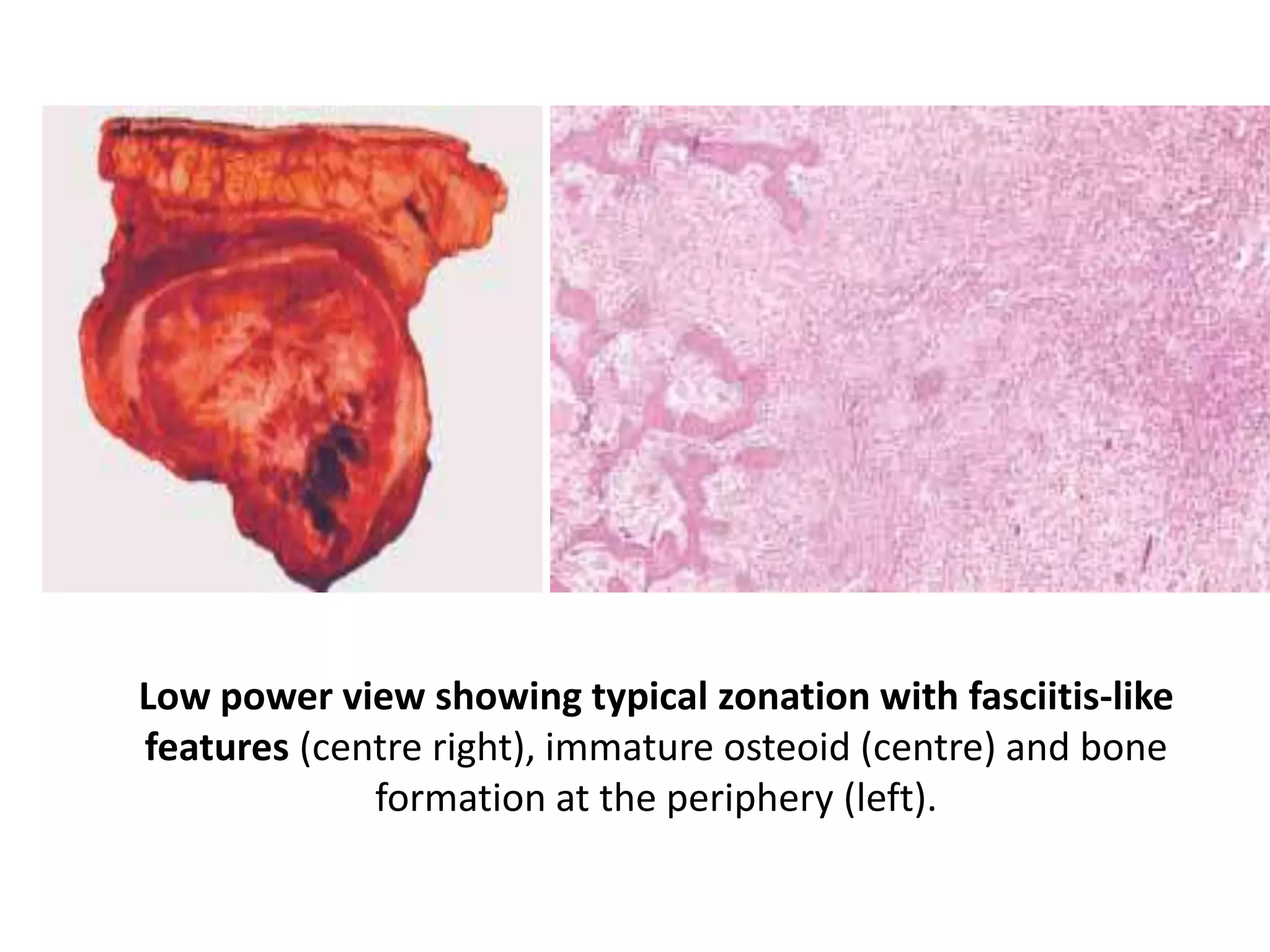 Pseudosarcoma | PPTX