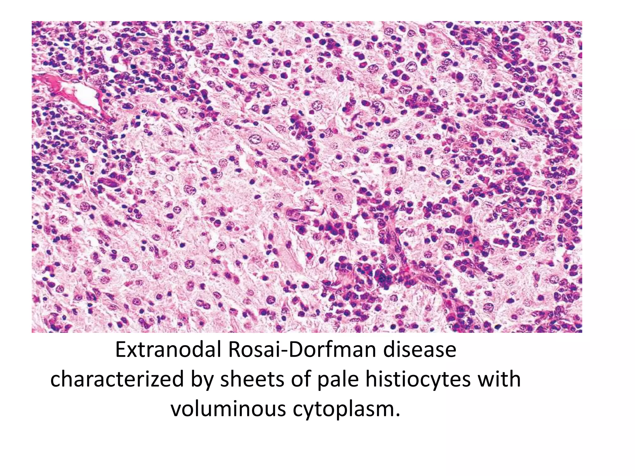 Pseudosarcoma | PPTX