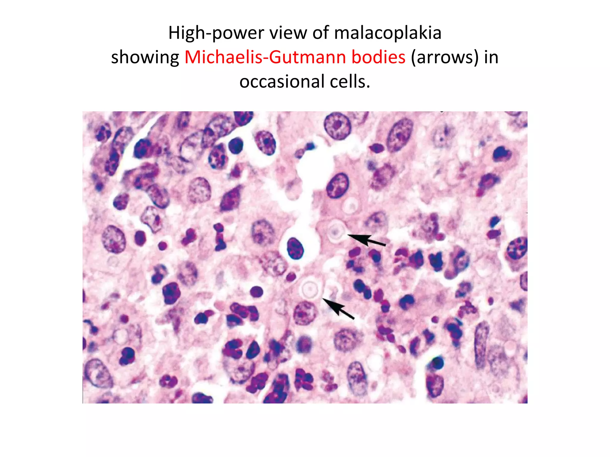 Pseudosarcoma | PPTX