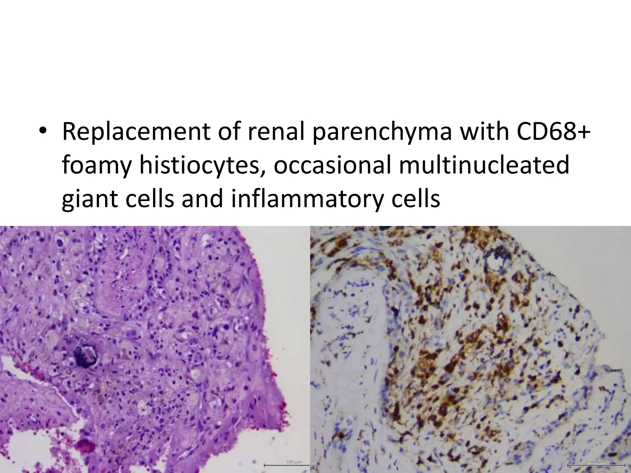 Pseudosarcoma | PPTX