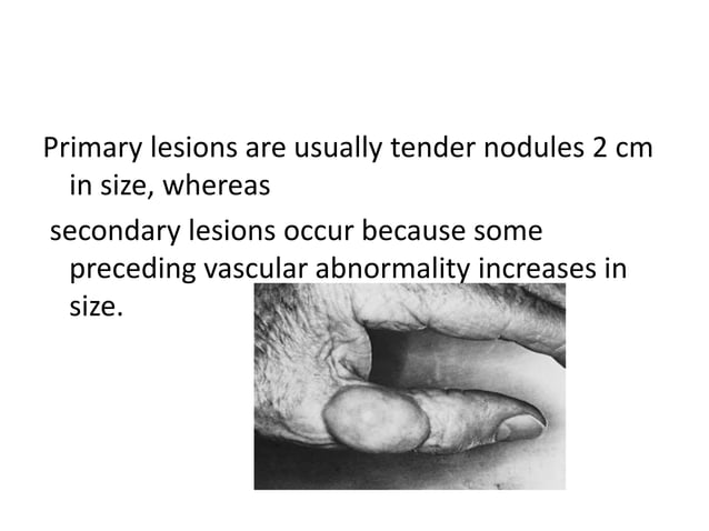 Pseudosarcoma | PPTX