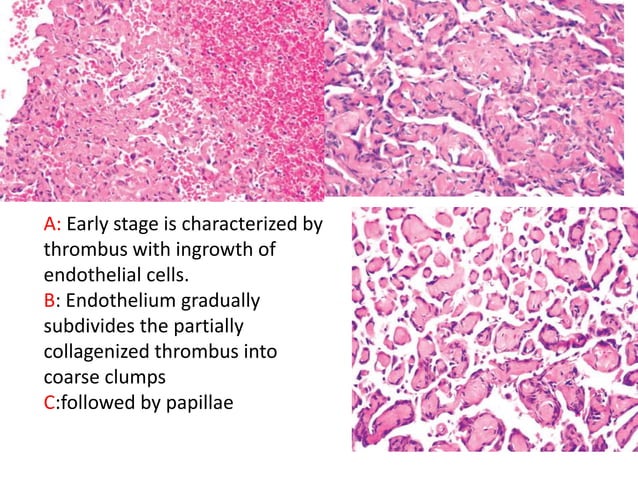 Pseudosarcoma | PPTX