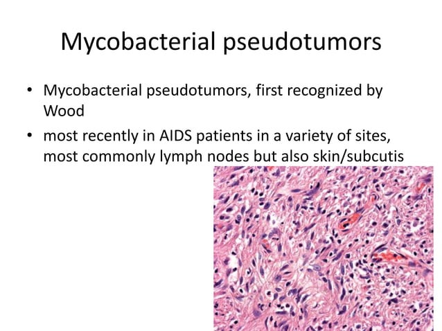 Pseudosarcoma | PPTX