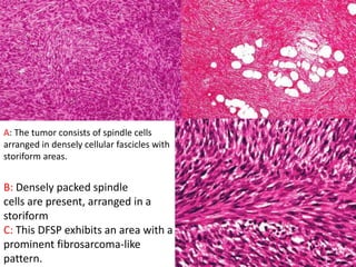 Pseudosarcoma | PPTX
