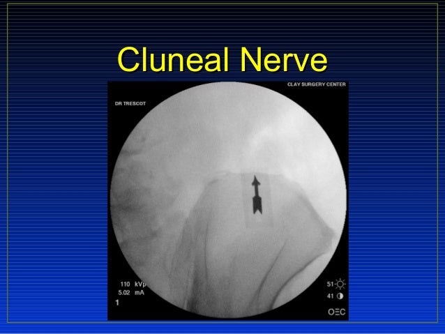 Pseudosciatica The Diagnostic Dilema Ppt