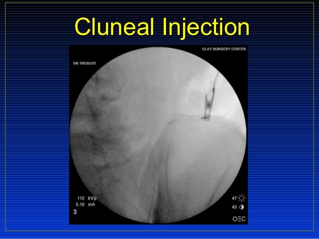 pseudosciatica-the diagnostic dilema.ppt
