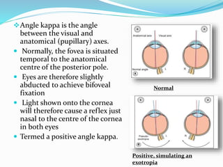 PSEUDOSTRABISMUS.pptx