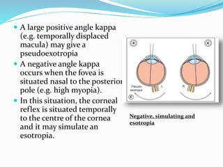 PSEUDOSTRABISMUS.pptx