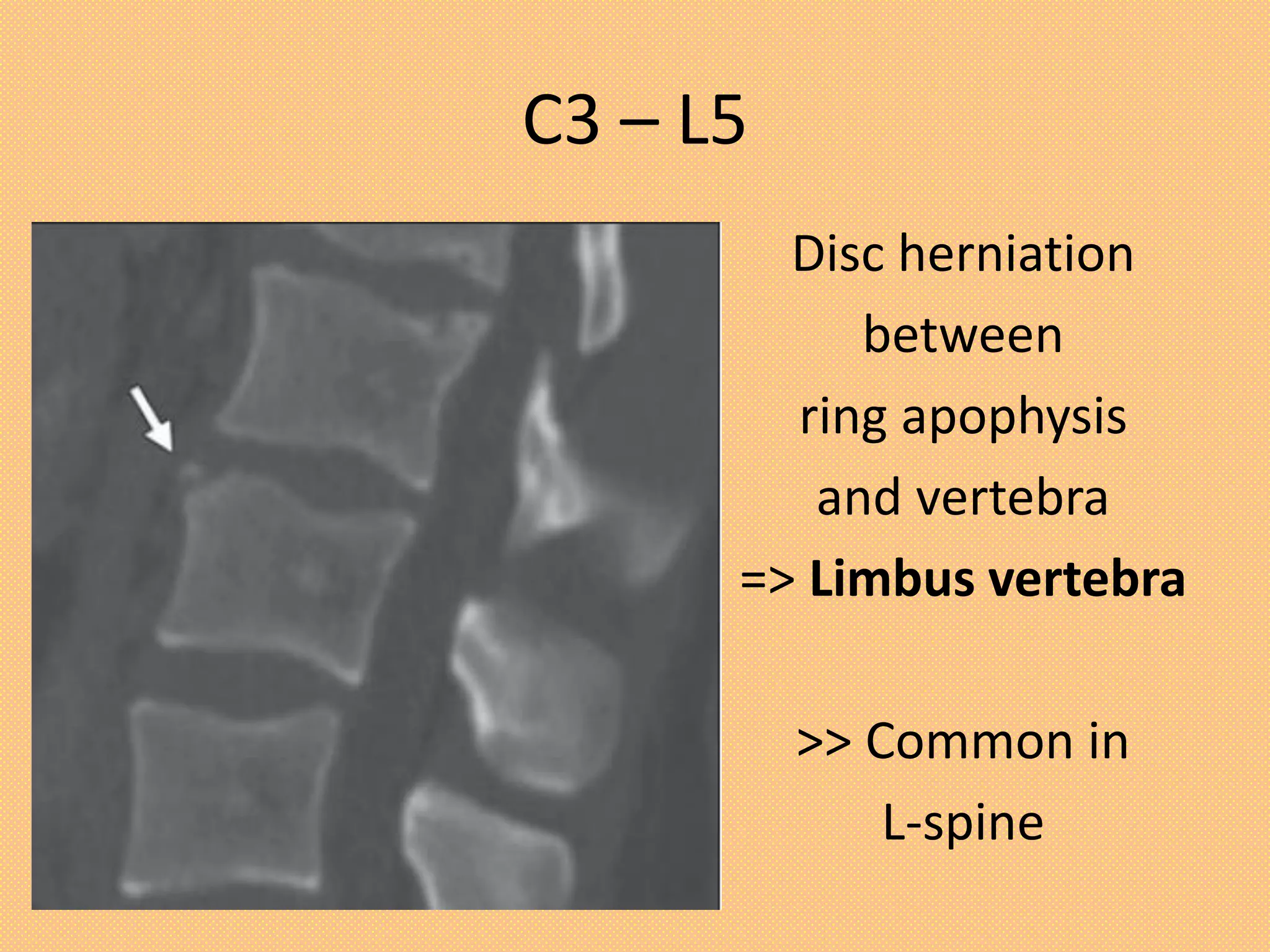 Pseudotrauma of the spine; the osseous variants | PDF