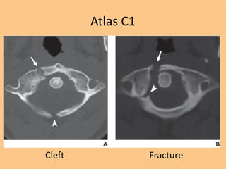 Pseudotrauma of the spine; the osseous variants | PDF