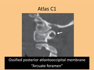 Pseudotrauma of the spine; the osseous variants | PDF
