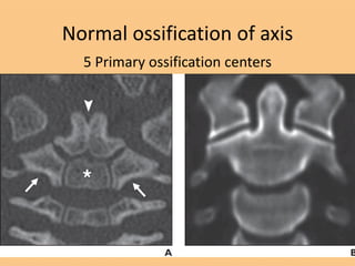 Pseudotrauma of the spine; the osseous variants | PDF