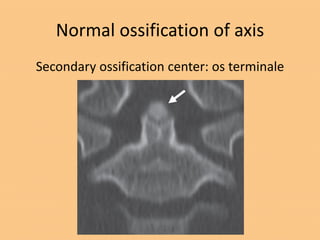 Pseudotrauma of the spine; the osseous variants | PDF