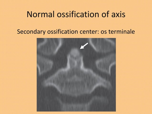 Pseudotrauma of the spine; the osseous variants | PDF