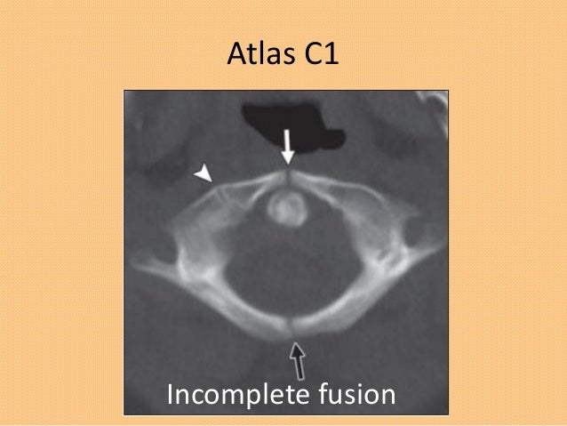 Pseudotrauma of the spine; the osseous variants