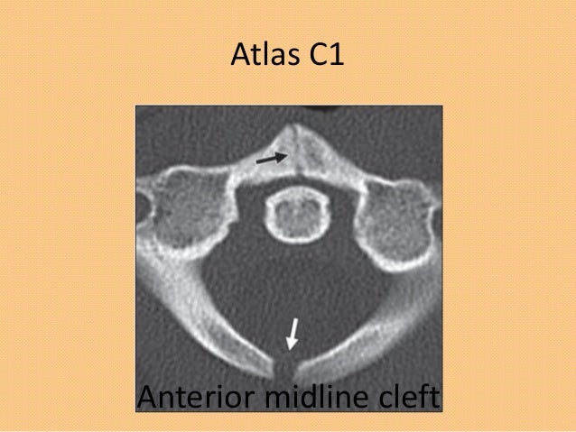 Pseudotrauma of the spine; the osseous variants