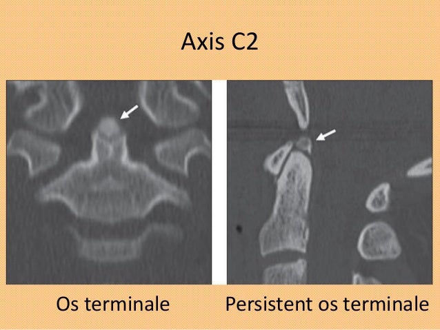 Pseudotrauma of the spine; the osseous variants