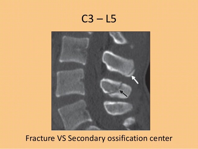 Pseudotrauma of the spine; the osseous variants