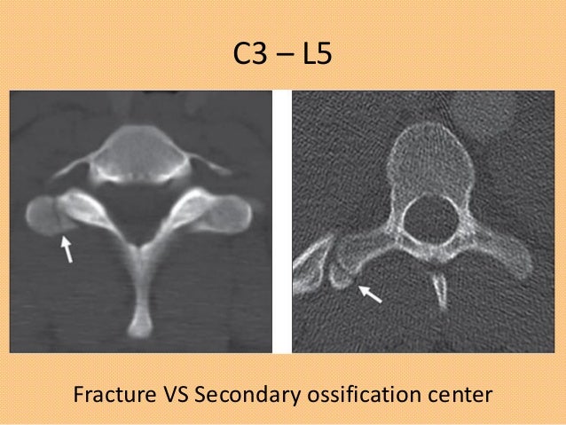 Pseudotrauma of the spine; the osseous variants