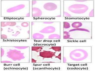 PS Findings In Hemolytic Anemia.pptx