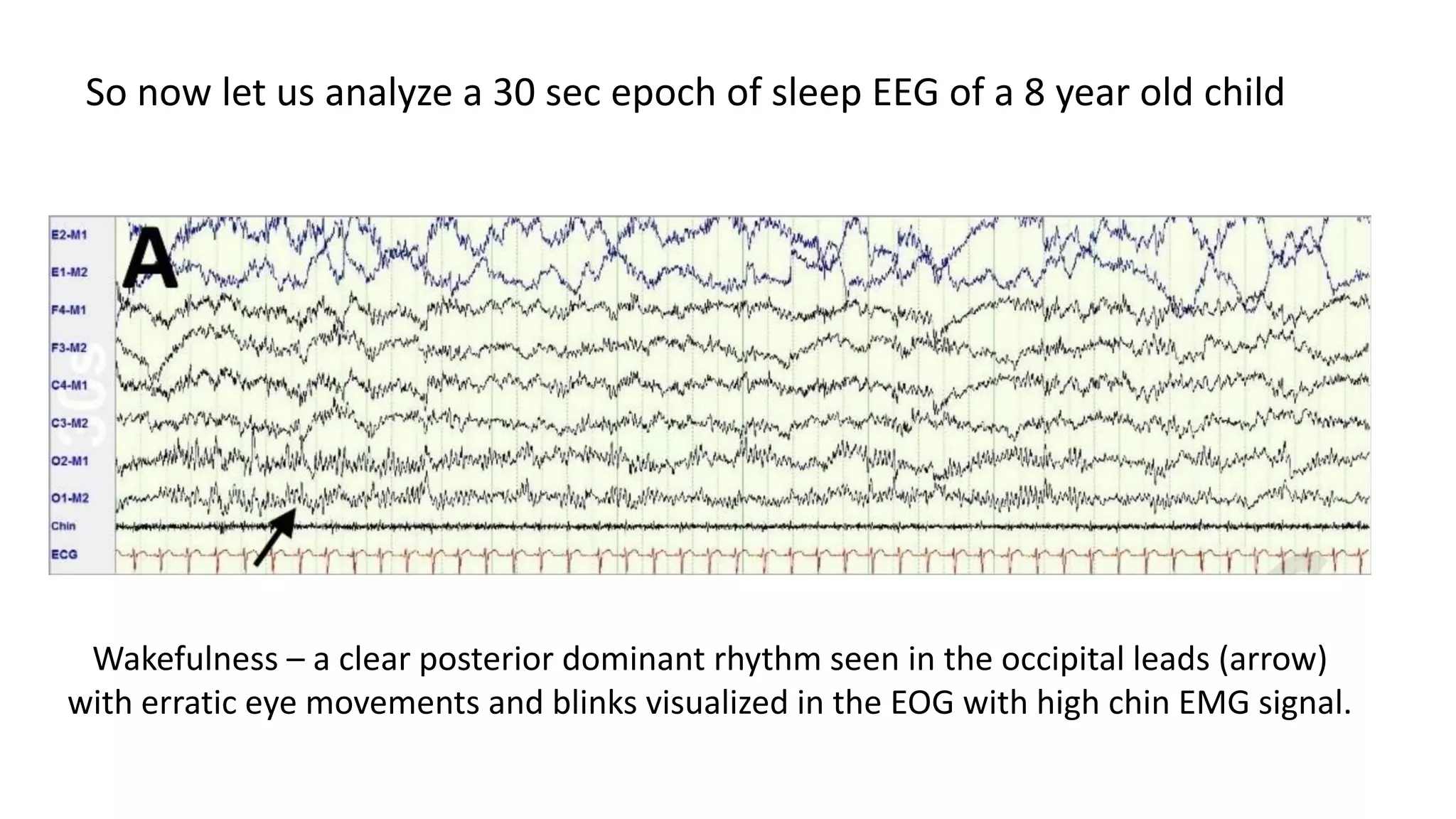Pediatric Polysomnography (Sleep study) | PPTX