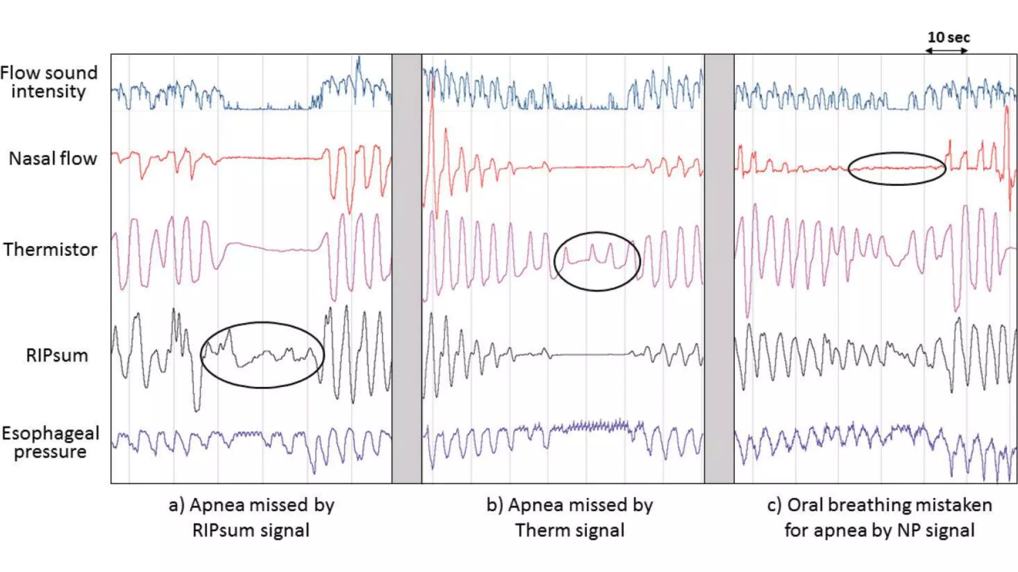 Pediatric Polysomnography (Sleep study) | PPTX