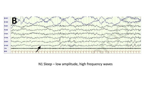 Pediatric Polysomnography (Sleep study) | PPTX | Ear, Nose and Throat ...