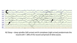 Pediatric Polysomnography (Sleep study) | PPTX