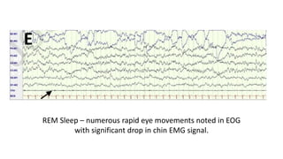 Pediatric Polysomnography (Sleep study) | PPTX