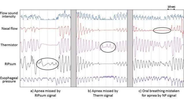 Pediatric Polysomnography (Sleep study) | PPTX | Ear, Nose and Throat ...