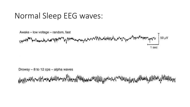 Pediatric Polysomnography (Sleep study) | PPTX | Ear, Nose and Throat ...