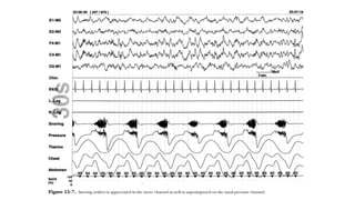 Polysomnography and its parameters- a complete overview. | PPT
