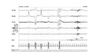 Polysomnography and its parameters- a complete overview. | PPT