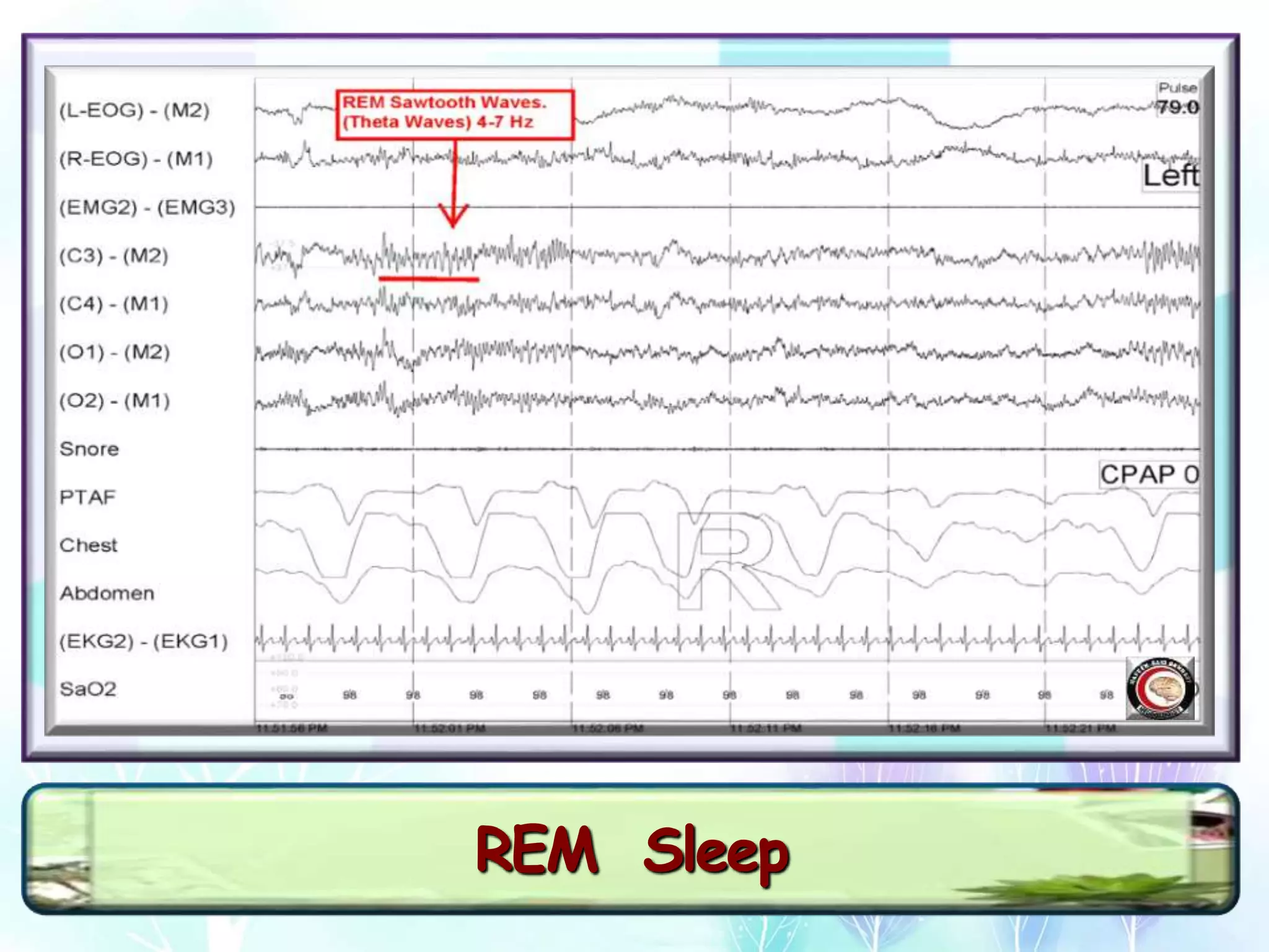 Polysomnogram interpretetion | PPTX