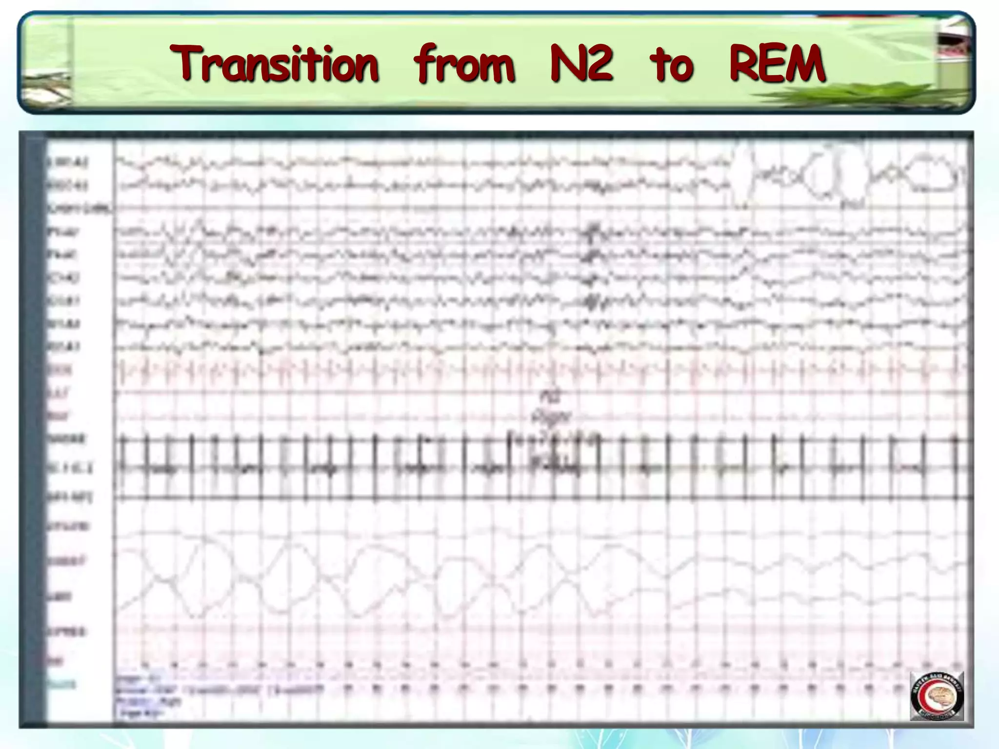 Polysomnogram interpretetion | PPTX