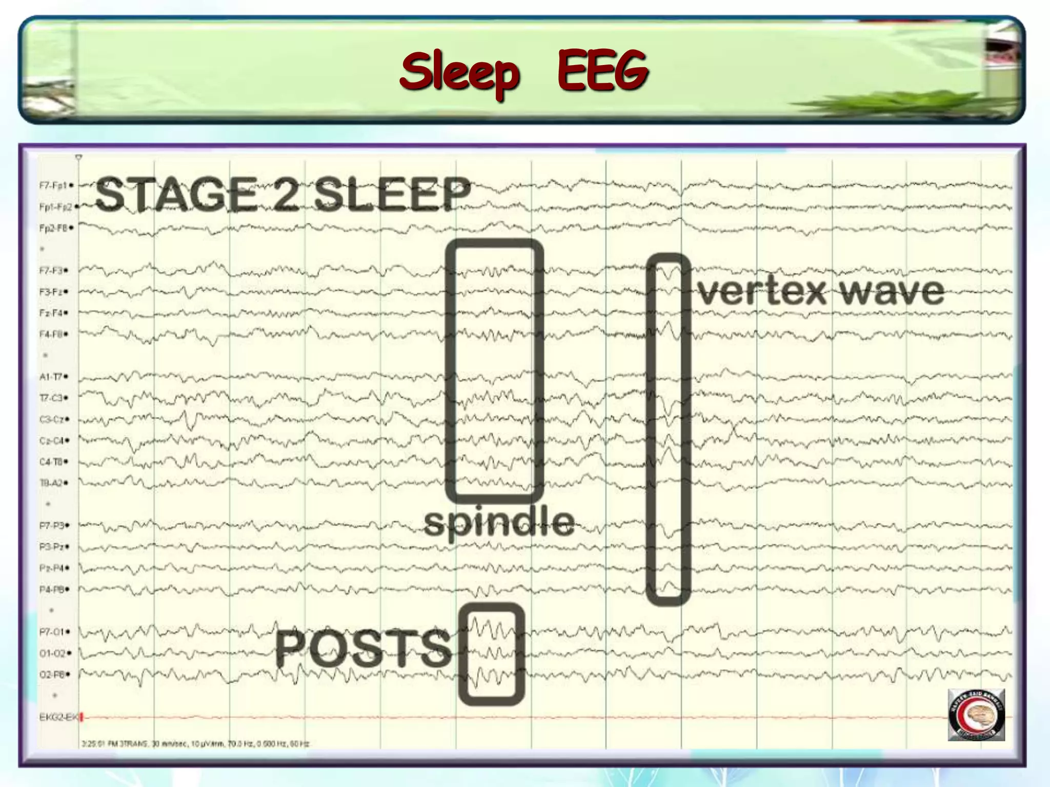Polysomnogram interpretetion | PPTX